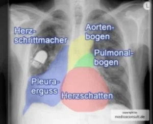 Herzinsuffizienz in Bildern - Facharztwissen