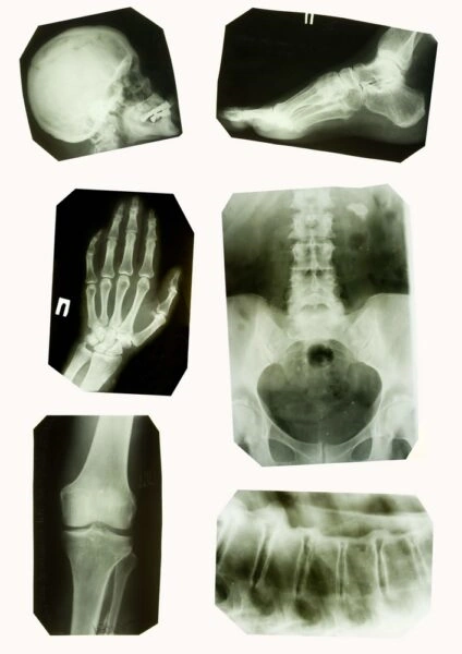 Rachitis - Facharztwissen