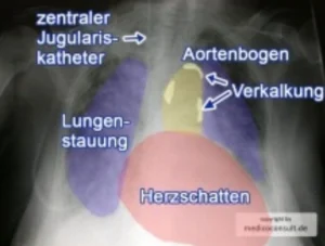 Herzinsuffizienz in Bildern - Facharztwissen