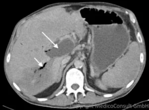Caroli-Syndrom - Facharztwissen