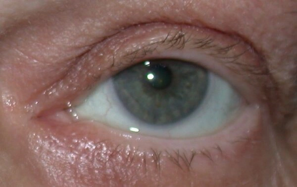 Adie-Syndrom - Facharztwissen