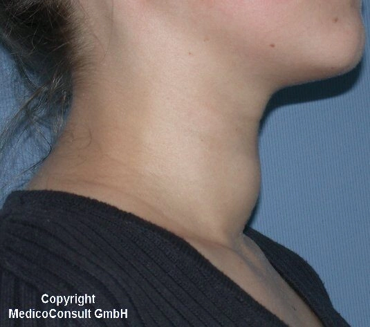 Latente Hyperthyreose - Facharztwissen