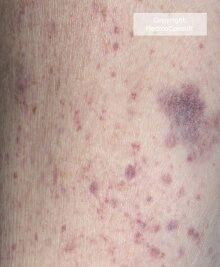 Chronisch lymphatische Leukämie - Facharztwissen
