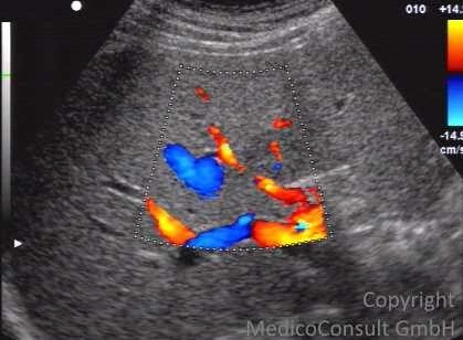 Duplexsonographie der Leber