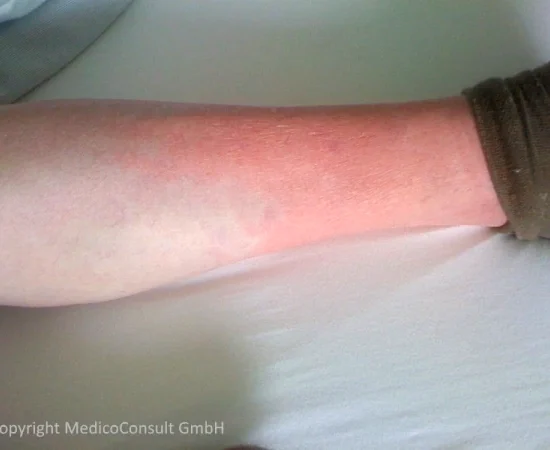Erysipel - Facharztwissen