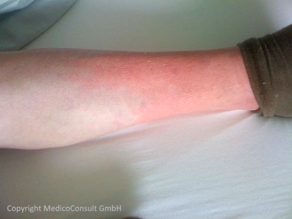 Erysipel - Facharztwissen
