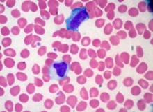 Differenzialblutbild - Facharztwissen