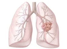 Therapie des Bronchialkarzinoms - Facharztwissen