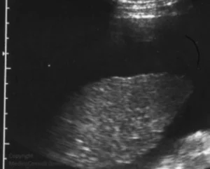 Sonographiebefunde bei Leberkrankheiten - Facharztwissen