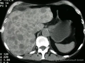 Hepatozelluläres Karzinom