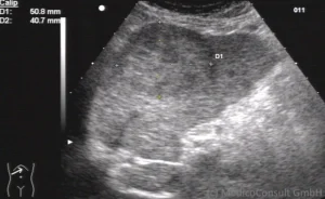 Sonographiebefunde bei Leberkrankheiten - Facharztwissen