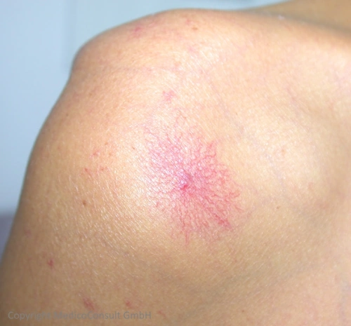 Leberhautzeichen - Facharztwissen