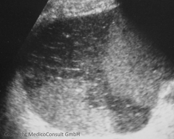 Sonographie der Milz - Facharztwissen