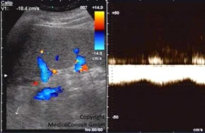 Sonographie der Milz - Facharztwissen