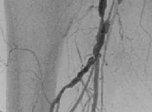 Arterielle Verschlusskrankheit - Facharztwissen
