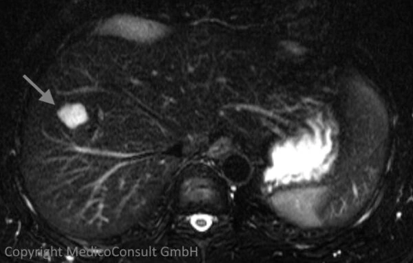 Leberhämangiom und Hämangioendotheliom - Facharztwissen