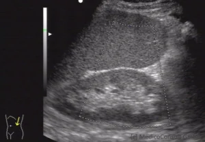 Sonographie der Milz - Facharztwissen